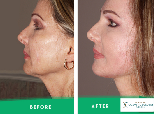 What is the importance of compression after facelift surgery? | Tampa ...