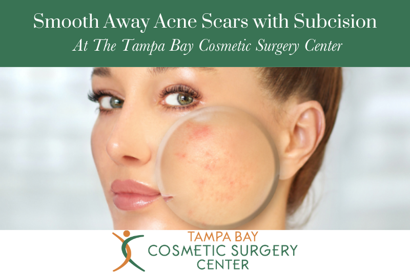 Smooth Away Acne Scars with Subcision At The Tampa Bay Cosmetic Surgery ...